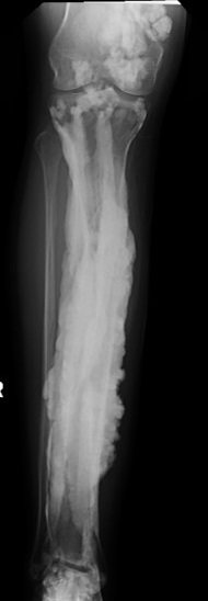 Researchers crack mystery behind rare bone disorder - Health Worlds News